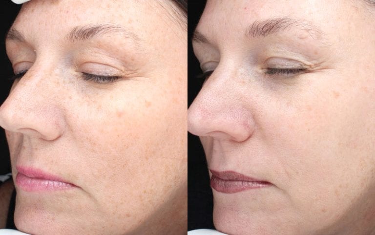 Jan Marini Skin Care | Before & After | LightRx MedSpa