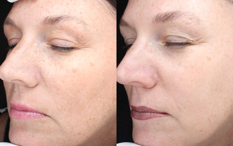 Jan Marini Skin Care Before And After Lightrx Medspa