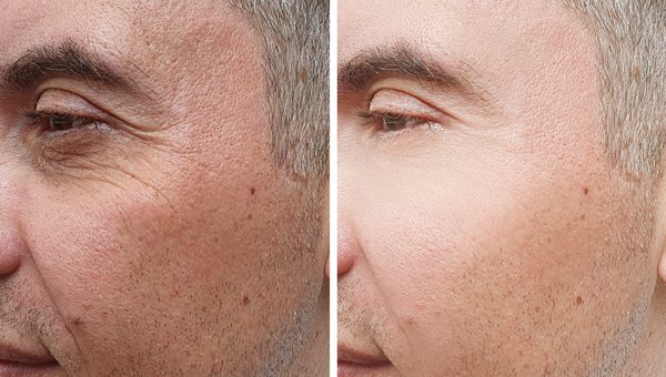 Botox & Filler Deals | LightRx