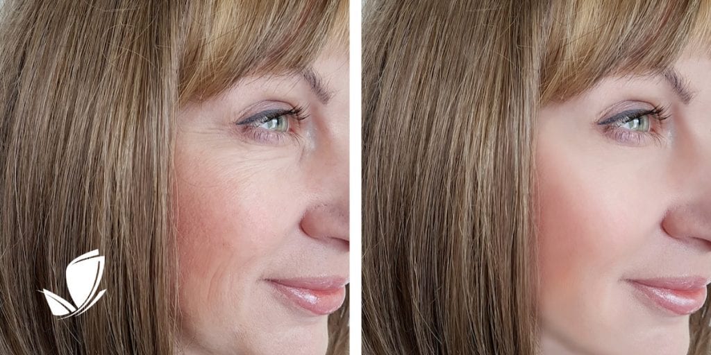 7 Botox Questions Answered | LightRx Skin