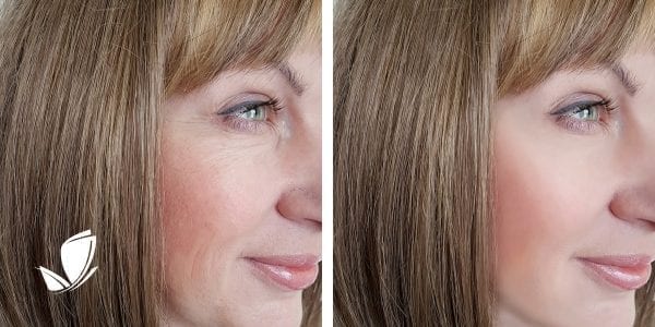 7 Botox Questions Answered | LightRx Skin